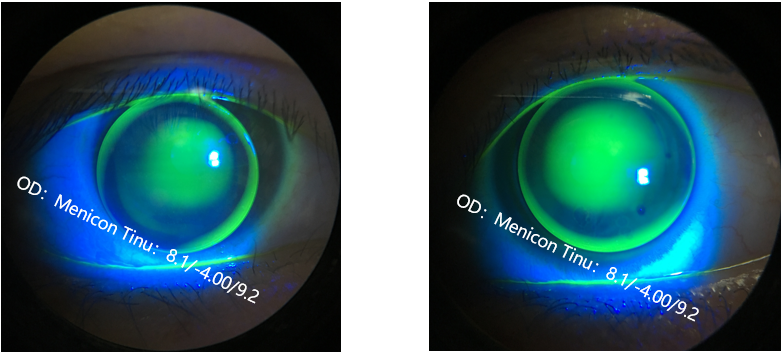 高度屈光参差与角膜屈光术后配戴目立康安氧视RGP的临床案例效果分析 - 目立康Menicon（美尼康）官网